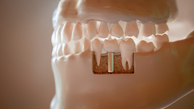 Are There Any Side Effects to Getting Dental Implants? - Valley Alder ...