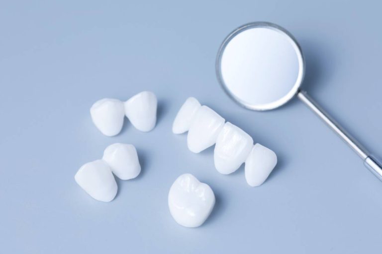 Avoiding Dental Bridge Problems - Valley Alder Family Dentistry