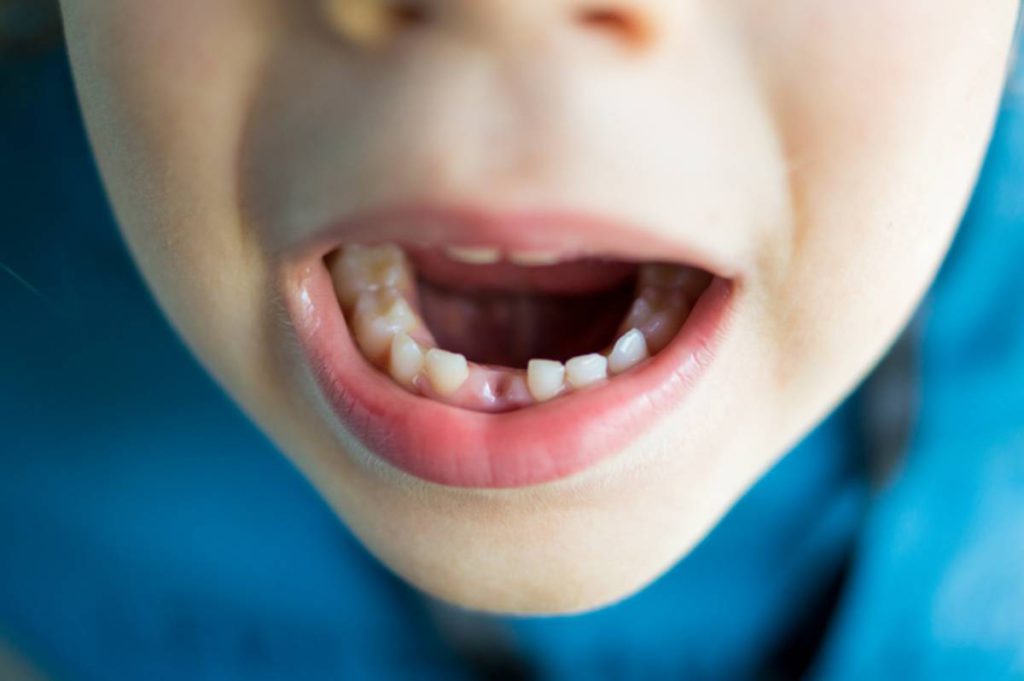 Is A Knocked Out Baby Tooth A Dental Emergency Valley Alder Family