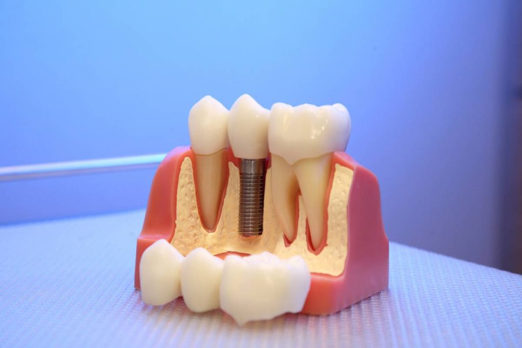 What Is Prosthodontics? - Valley Alder Family Dentistry